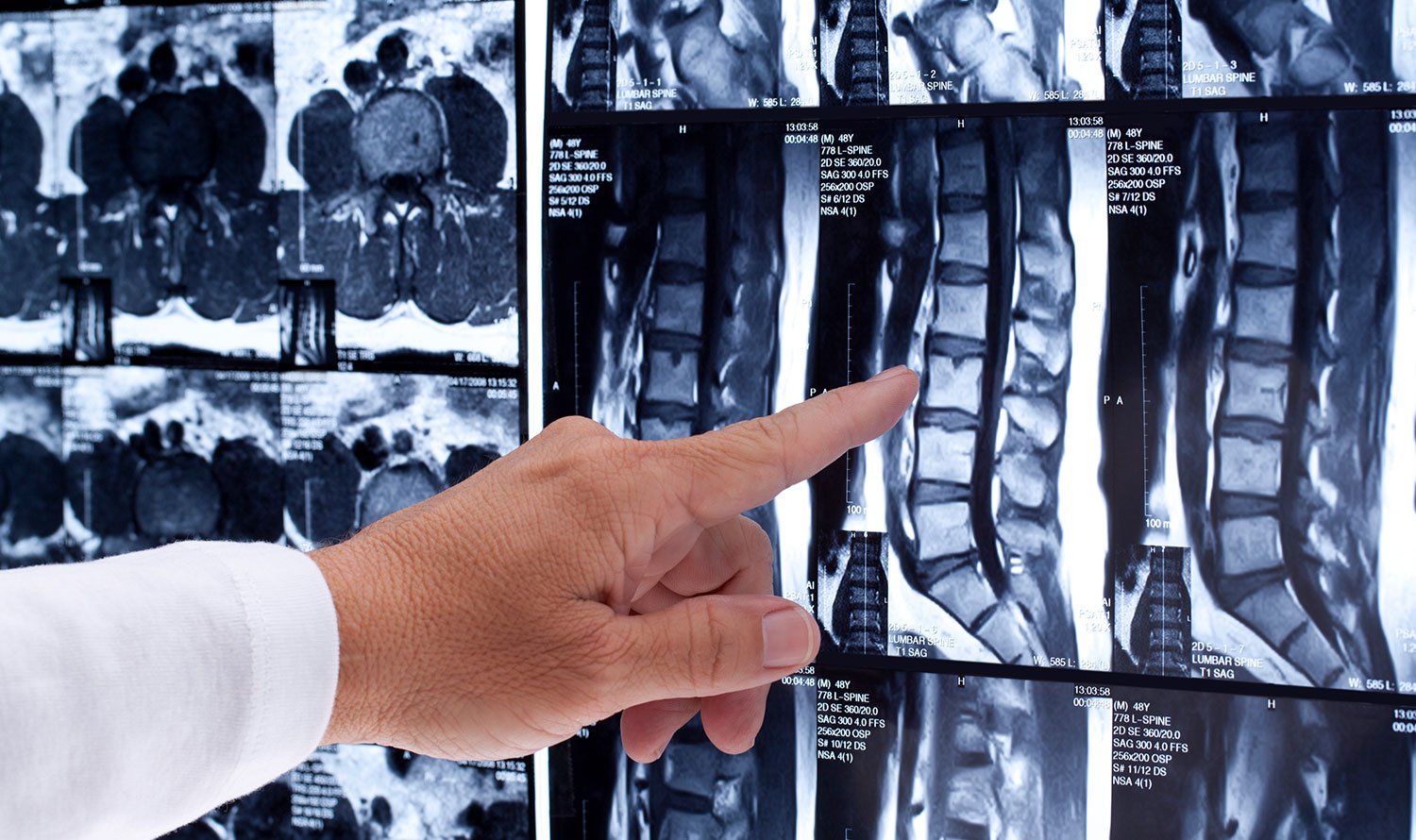 Minimally Invasive Spinal Surgery Long Island | Dr. Kakoulides